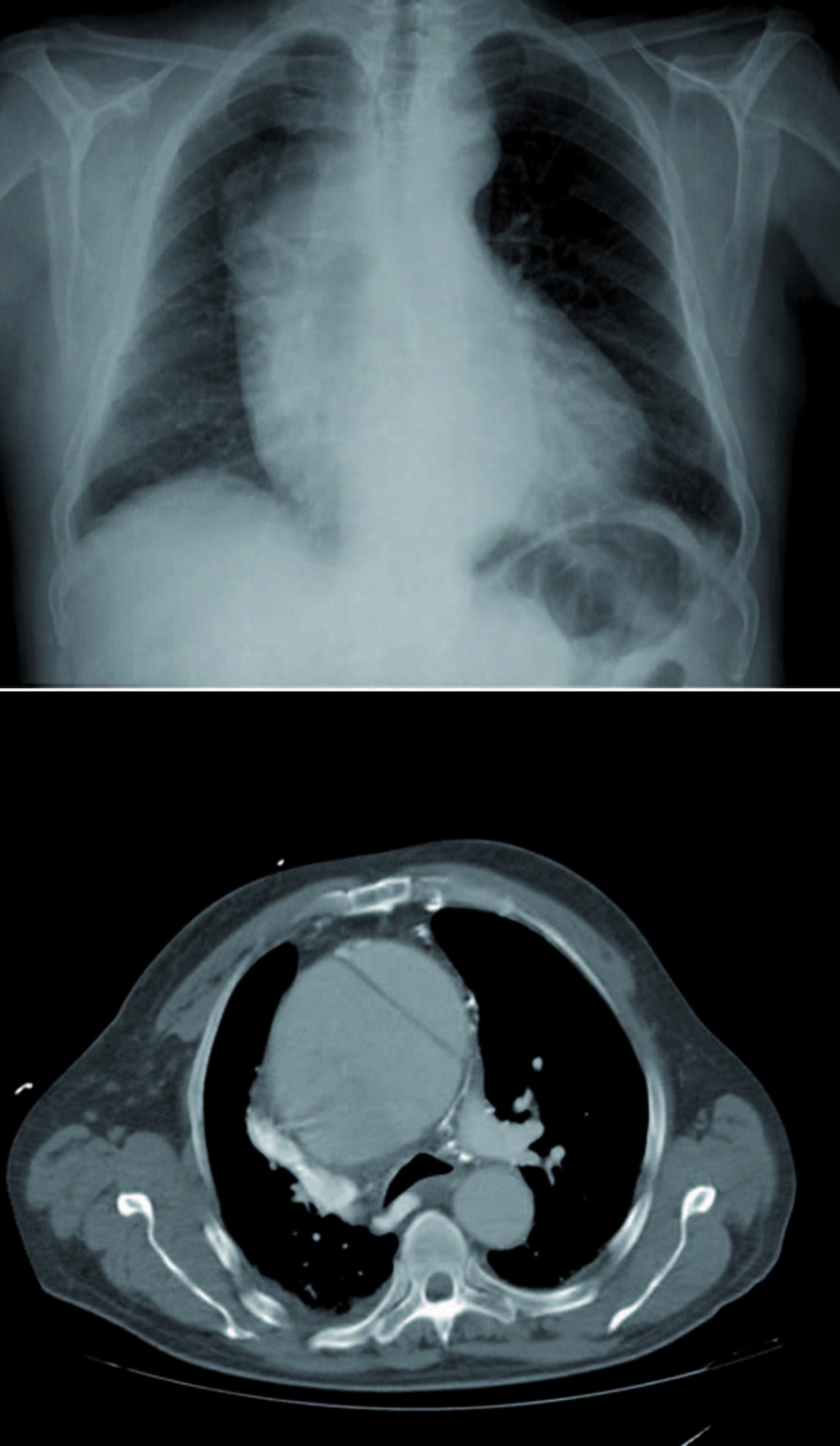 Radiografia toracica e TAC - Bald Mountain Science