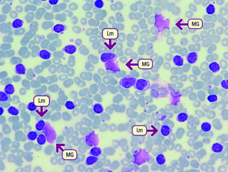 La leucemia linfatica cronica (CLL) - Bald Mountain Science