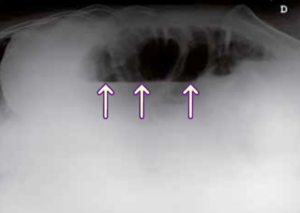 L’ileo meccanico e l’ileo paralitico in radiologia – Bald Mountain Science
