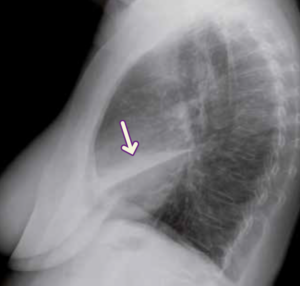 Il versamento pleurico, l’atelettasia e la tromboembolia polmonare (TEP ...