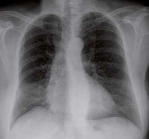 Il versamento pleurico, l’atelettasia e la tromboembolia polmonare (TEP ...