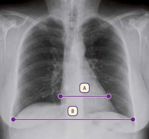 Metodologia dell’interpretazione di una radiografia del torace – Bald ...