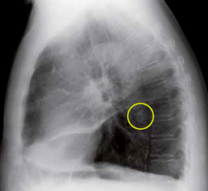 Nodulo polmonare solitario, multipli, carcinoma broncogeno e ...