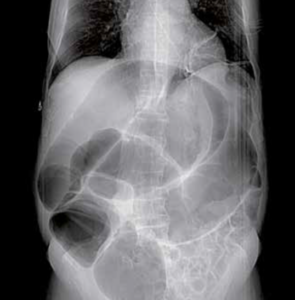 L’ileo meccanico e l’ileo paralitico in radiologia – Bald Mountain Science