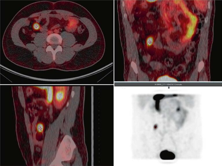 La scintigrafia del diverticolo di Meckel – Bald Mountain Science