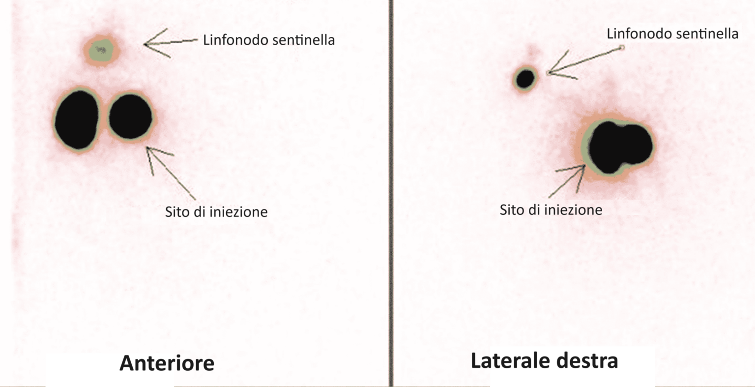 La linfoscintigrafia per la ricerca del linfonodo sentinella in ...