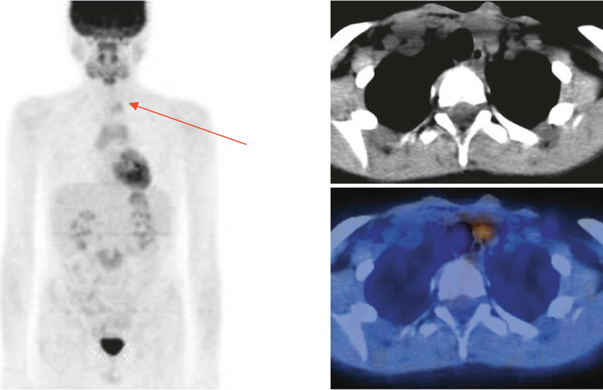 PET-FDG: distribuzione normale, varianti e artefatti (vs assorbimento ...