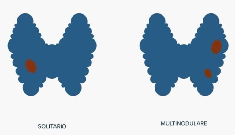 L’adenoma tossico e il gozzo tossico multinodulare – Bald Mountain Science