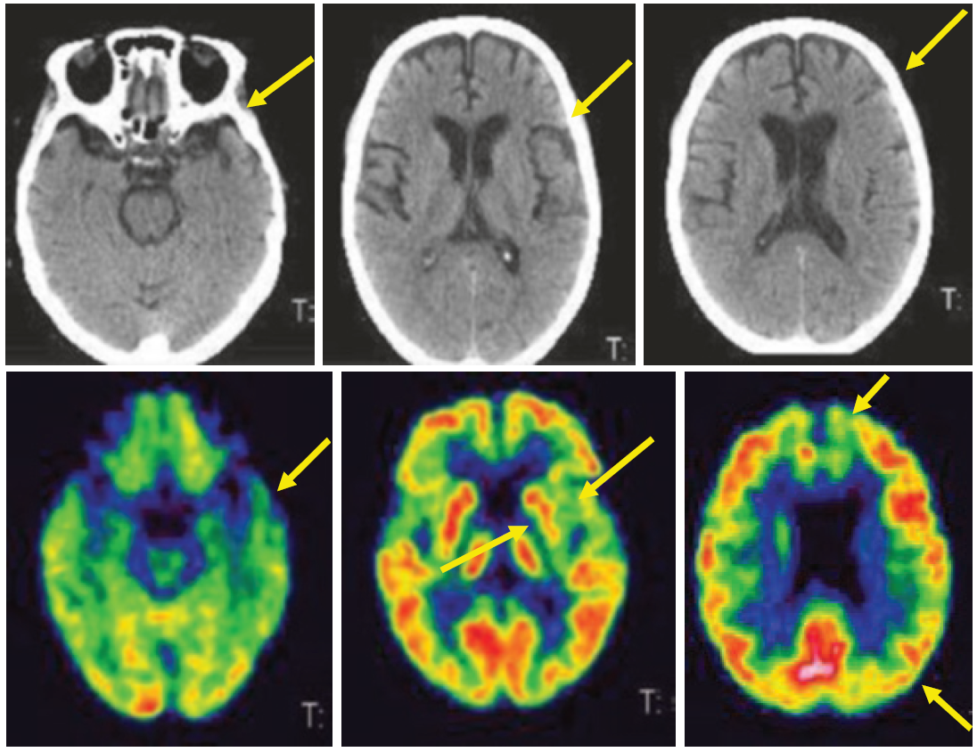 L’utilizzo della PET con FDG nelle patologie cerebrali (pattern ed ...