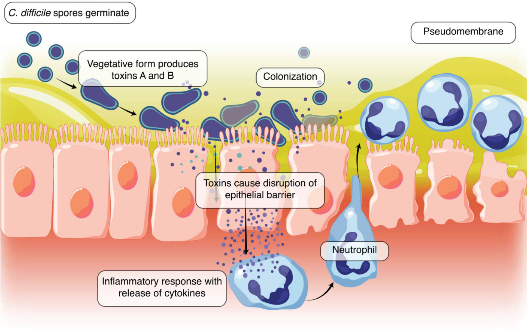 L’infezione da Clostridioides difficile (Clostridioides difficile ...