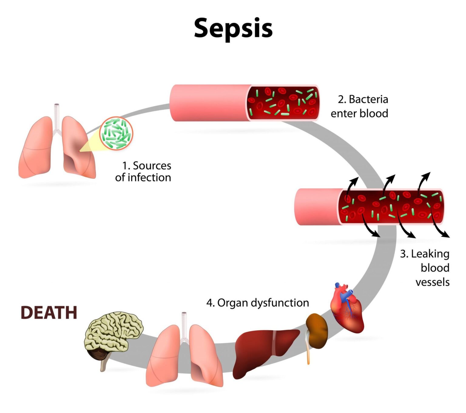 Sepsi: la corsa contro il tempo – cosa sapere, come riconoscerla, come ...