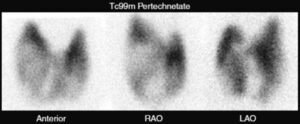 La medicina nucleare nella diagnosi e terapia delle patologie tiroidee ...